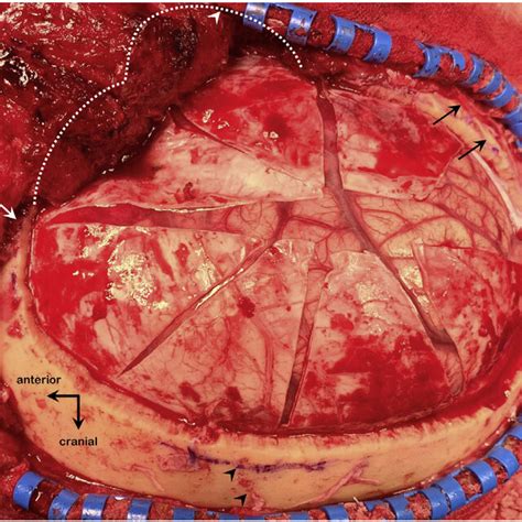 A 3d Ct Scan Major Bone Landmarks For Decompressive Craniectomy B Download Scientific