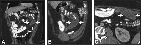 Intestinal Malrotation And Acute Left Sided Appendicitis Journal Of