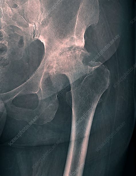 Abnormal Hip X Ray Abnormal Hip X Ray