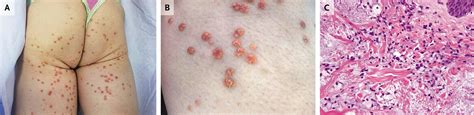 Eruptive Xanthoma NEJM