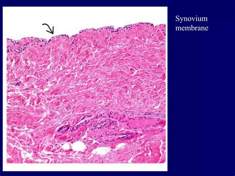 Soft Tissue Tumorppt
