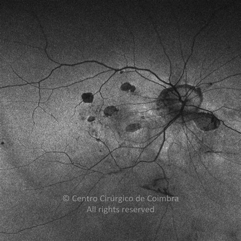 Caso Clínico 3 Atlas Rl Eye