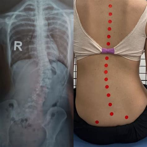 不同程度脊柱侧弯是什么样子 知乎