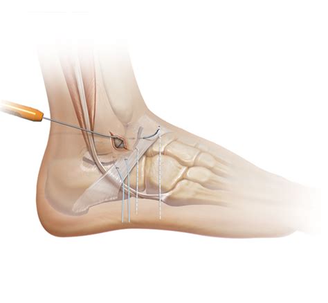 Arthrex Arthrex® Brostrom Repair