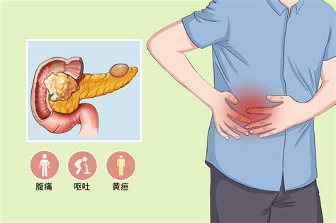 胰腺假性囊肿 有来医生