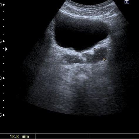 Findings Suggestive Of Ejaculatory Duct Obstruction During