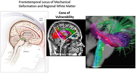 left from ropper and gorson 2007 depicting the movement of brain