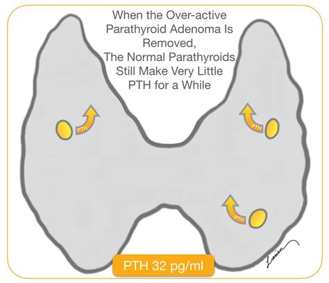 Parathyroid Adenom Parathyroid Adenoma