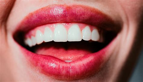 Cosmetic Bonding For Chipped Front Teeth