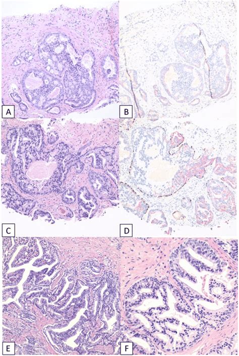 A Acinar Adenocarcinoma With Cribriform Growth Pattern Gleason Pattern