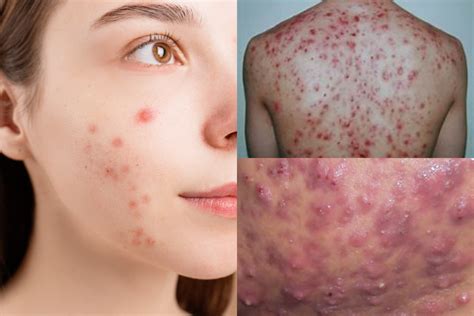 Acne Conheça Os 5 Graus Da Doença E Suas Causas Fala Universidades