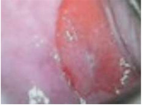 Cervix In The Process Of Healing During Tb Treatment Discussion