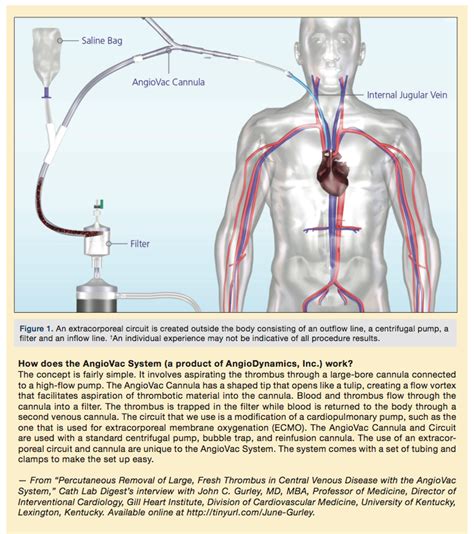 A Clinicians Experience In Developing A Practice With The Angiovac System