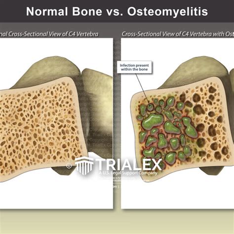 Medical Legal Exhibits Legal Animations And Trial Graphics Tria