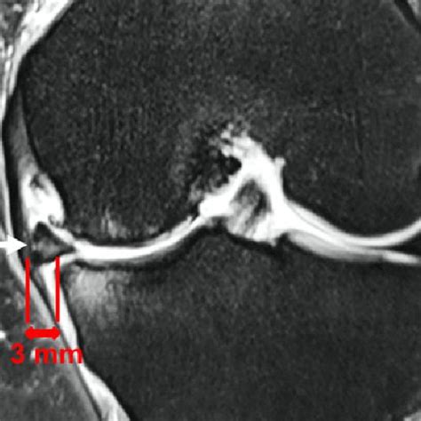 Illustration Of Repair Techniques For Meniscal Extrusion A Coronal