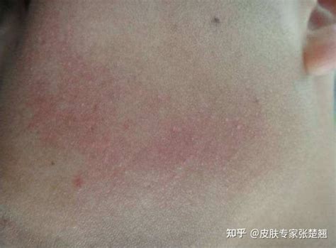 脸颊两侧又红又粗糙到底是啥 知乎