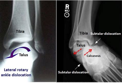 Best Practices Effective Reduction Techniques For Lower Extremity