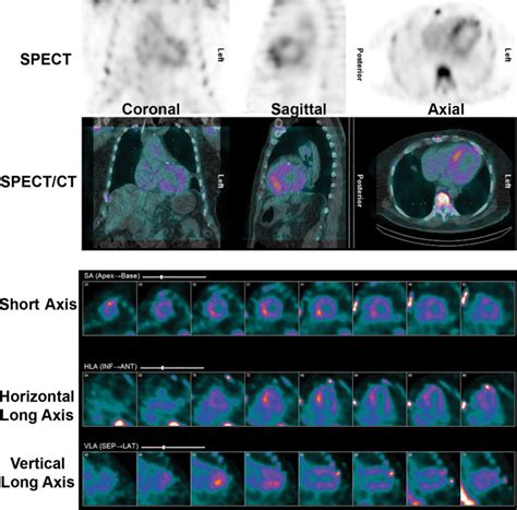 99mtc Bone Avid Tracer Cardiac Scintigraphy Role In Noninvasive Diagnosis Of Transthyretin