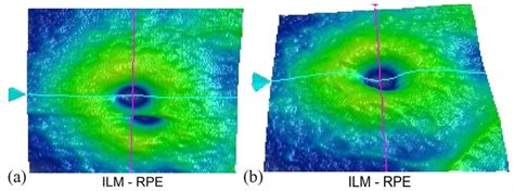 Enface Oct Maps Before And After Pupillary Dilation A And B The