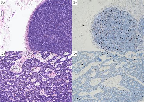 Histological Findings And Pathologic Diagnosis Of Spiradenocarcinoma A