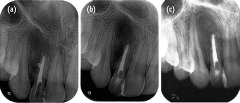 Treatment Radiographs Of Case 2 A Pre Operative Radiograph B