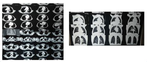 Ct Scan Images Showing A Collection In Sternal Region Extending Up To Download Scientific