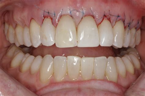 Allograft Issaquah Wa Northwest Periodontics And Implants