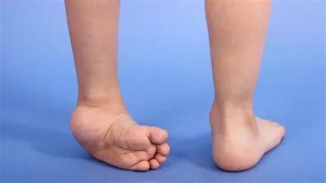 Understanding Clubfoot Congenital Talipes Equinovarus Causes