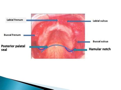 Maxillary Denture Landmarks