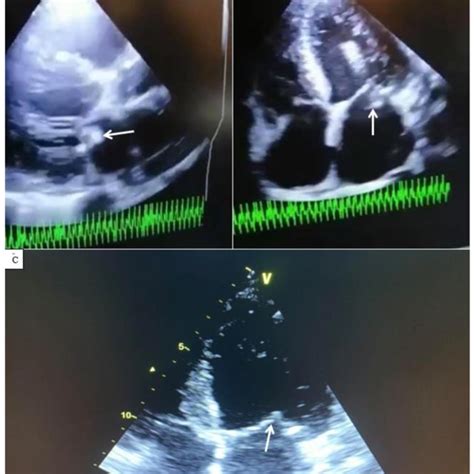 Transthoracic Echocardiogram A Showing Vegetation At The Expense Of