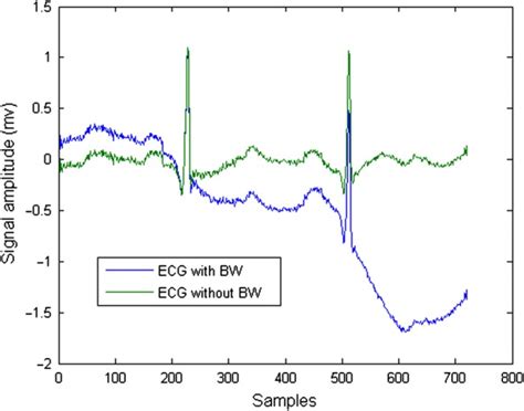 Baseline Wander Removal Of Electrocardiogram Signals Using Multivariate
