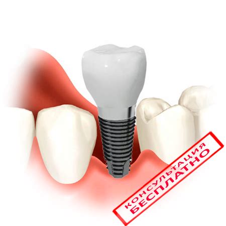 Санация полости рта перед зубной имплантацией обязательна