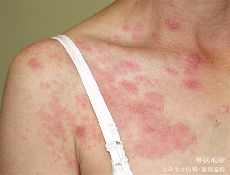 汎発疹帯状疱疹 汎発性帯状疱疹 とは Pielfv