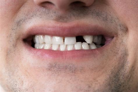 What Is Meth Mouth Handling Teeth Loss From Addiction