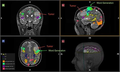 Cureus Reconciling Functional Mri Findings With Intraoperative