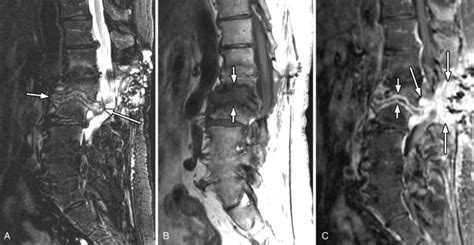 Osteomyelitis And Discitis Spondylodiscitis Radiology Key