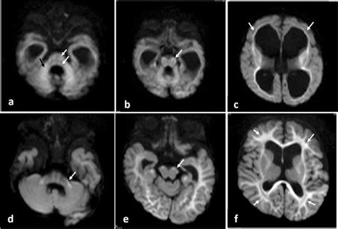 Sequential Axial DWI Demonstrating Different Distributions Of Diffusion Download Scientific