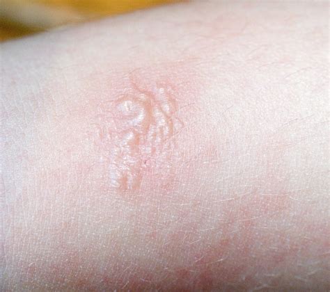 Minor Poison Ivy Rash On Face