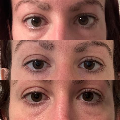 Mild Ptosis R Myastheniagravis
