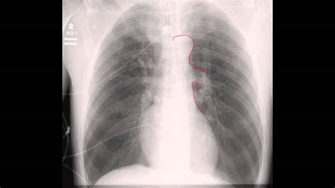 Basic Cxr Assessment Youtube