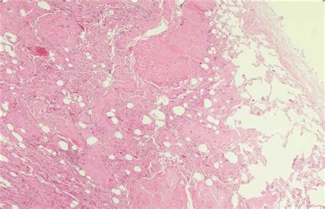 Section Of A Lung Biopsy Which Displays Subpleural Fibroelastosis B