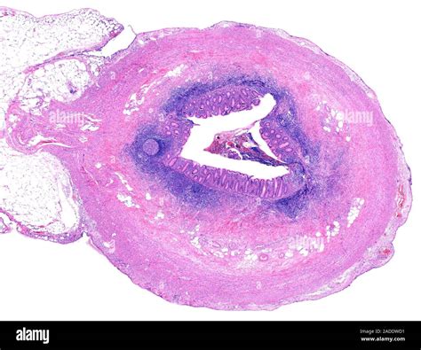 Light Micrograph Of A Cross Section Through An Appendix Removed Due To An Acute Appendicitis