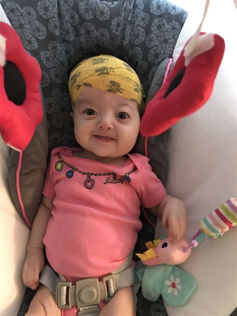 Apert Syndrome Newborn