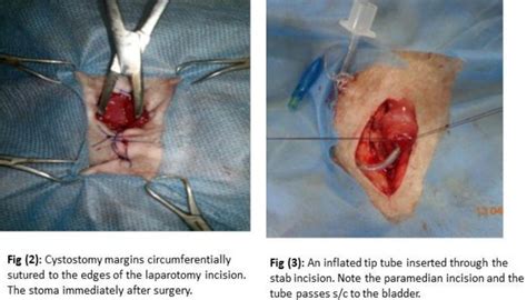Tube Cystostomy Vs Bladder Marsupialization Clinical And