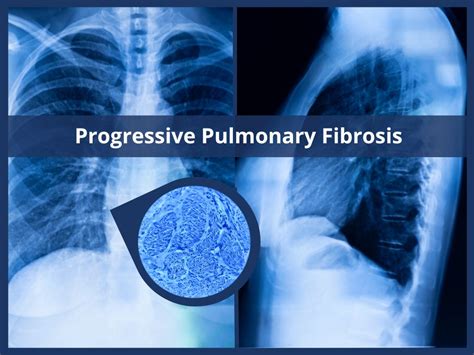 Exploring Immune Profiles In Progressive Pulmonary Fibrosis