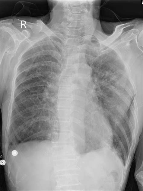 Premium Photo Film Chest X Ray Finding Interstitial Pulmonary
