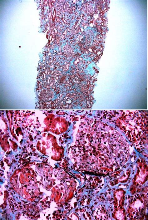 Thu0600 A Case Of Systemic Sclerosis Complicated By Renal Crisis