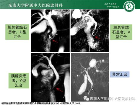 【ppt】胰胆管合流异常 影像ppt