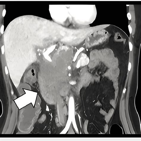 Multislice Computed Tomography Msct Of The Pancreas Showed