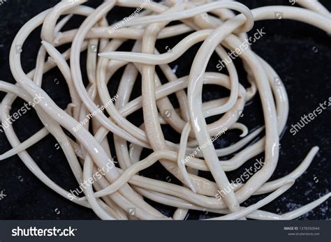 Ascariasis Disease Caused By Parasitic Roundworm